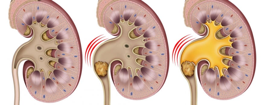 I calcoli renali vengono a causa dell'acqua del rubinetto?